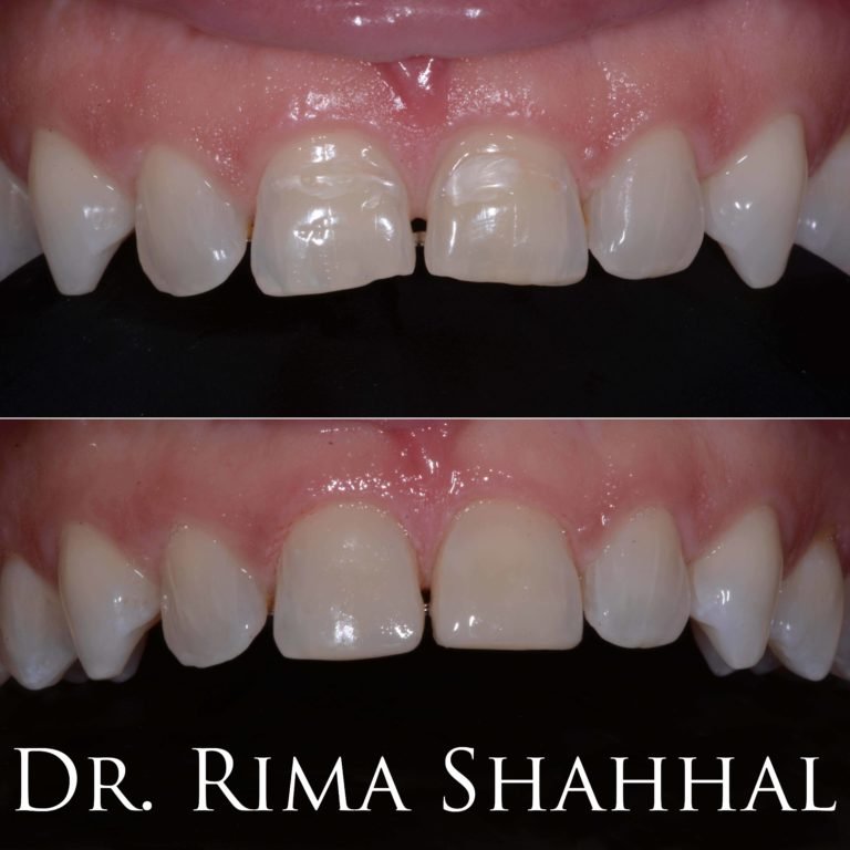 North County Dental Filling | Dental composite filling was used to ...